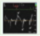 TTE 의학용어 echo 검사 결과 해석 RWMA EF E/e' 의미 Transthoracic Echocardiography ...