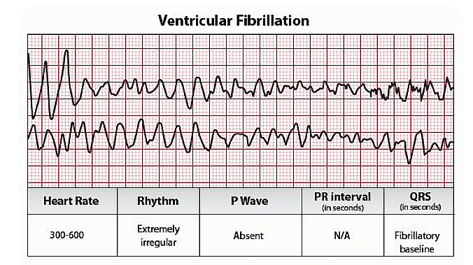 심실세동 VF Vfib ventricular fibrillation 정의 원인 심전도 증상 시술 치료 (+CPR ...