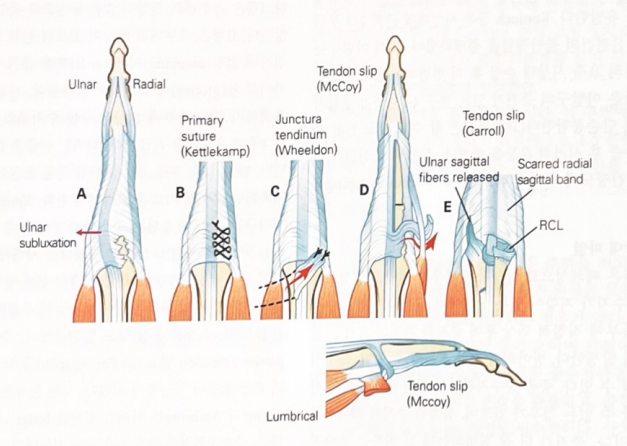 [정형외과 전문의] 신전건 파열, Extensor tendon injury (수부외과) : 네이버 블로그