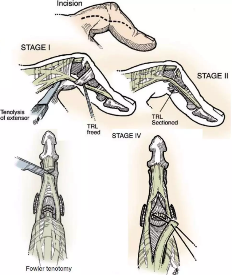 [정형외과 전문의] 신전건 파열, Extensor tendon injury (수부외과) : 네이버 블로그