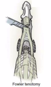 [정형외과 전문의] 신전건 파열, Extensor tendon injury (수부외과) : 네이버 블로그