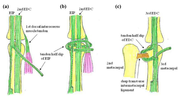 [정형외과 전문의] 신전건 파열, Extensor tendon injury (수부외과) : 네이버 블로그