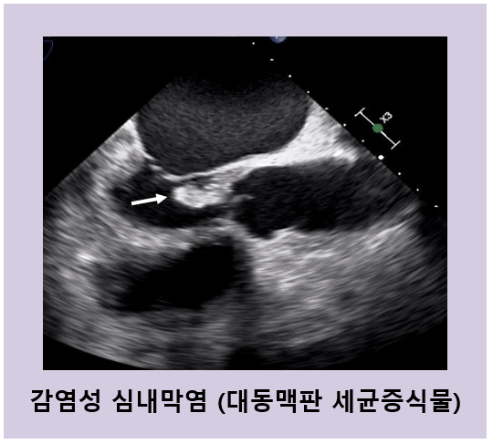 Tee 의학용어 경식도심초음파 검사 목적 적응증 전후 준비사항 Transesophageal 네이버 블로그