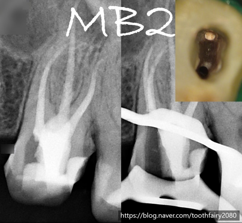 [재신경치료] 크라운 씌운 치아가 뜨거운 음식에 아파요. (esp. 상악제1대구치 MB2) : 네이버 블로그