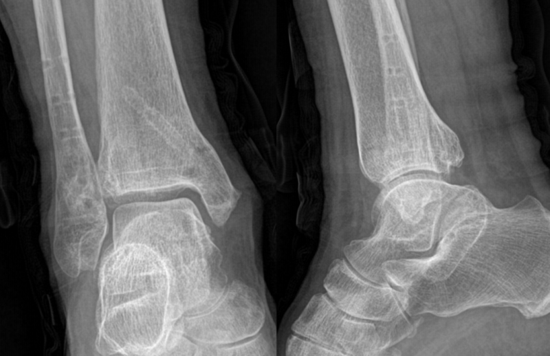 발목 골절의 치료 (ankle fracture, bimalleolar fracture) : 네이버 블로그