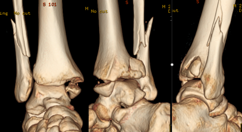 발목 골절의 치료 (ankle fracture, bimalleolar fracture) : 네이버 블로그