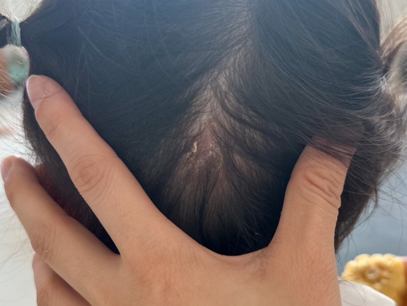 아기 농가진 전염 증상 원인 아기 피부염 유아 농가진 연고 네이버 블로그