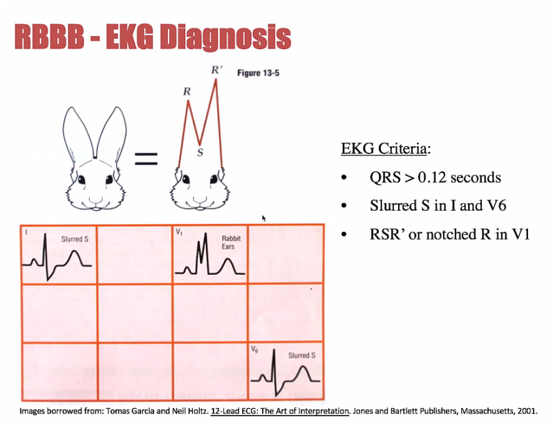 우각차단 RBBB right bundle branch block 원인 증상 심전도 EKG 특징 예후 치료 (+심장 자극전도계 ...