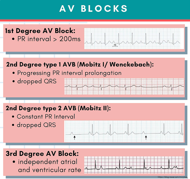 방실차단 AV block, atrioventricular block 종류 심전도 검사 치료 (+complete block ...