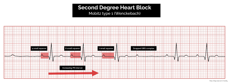 방실차단 AV block, atrioventricular block 종류 심전도 검사 치료 (+complete block ...