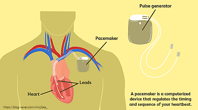 방실차단 AV block, atrioventricular block 종류 심전도 검사 치료 (+complete block ...