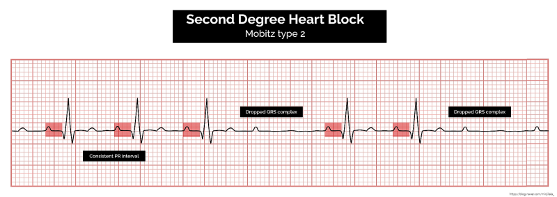 방실차단 AV block, atrioventricular block 종류 심전도 검사 치료 (+complete block ...