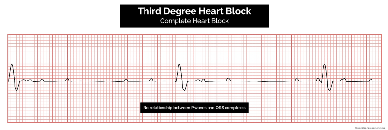 방실차단 AV block, atrioventricular block 종류 심전도 검사 치료 (+complete block ...