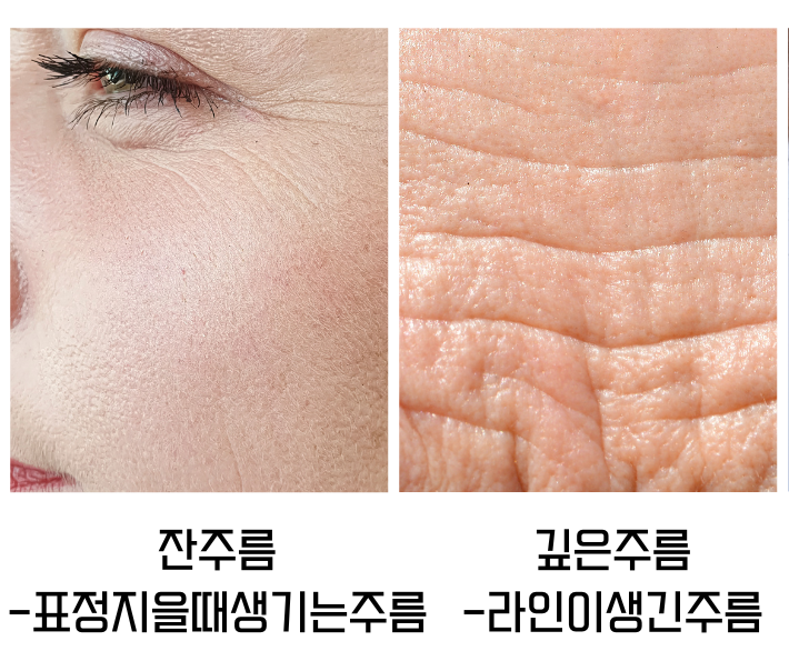 보톡스 스킨보톡스와 보톡스의 차이점 효과부작용주의할점 네이버 블로그