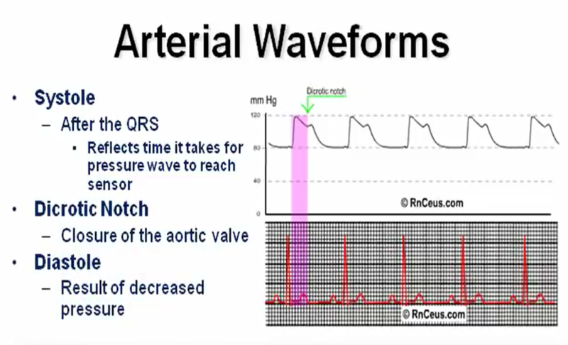 ABP monitoring 및 A-line 관리하는 방법 : 네이버 블로그