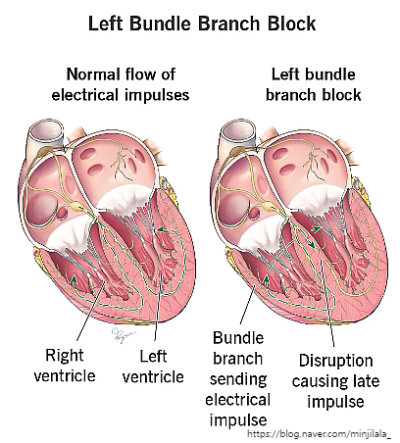 좌각차단 LBBB left bundle branch block 부정맥 원인 심전도 특징 증상 치료 (+우각차단 RBBB 차이점 ...