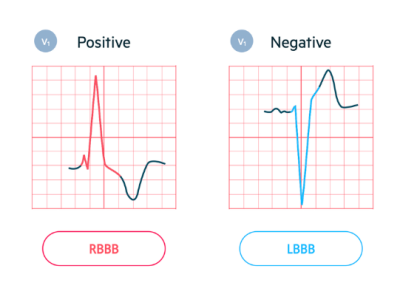 좌각차단 LBBB left bundle branch block 부정맥 원인 심전도 특징 증상 치료 (+우각차단 RBBB 차이점 ...
