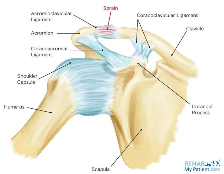 I OR&IF c Hook Plate(AC-CC Ligament Injury, Clavicle, 견봉&오구쇄골 인대손상) I ...