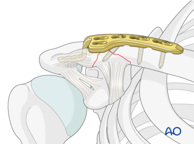 I OR&IF c Hook Plate(AC-CC Ligament Injury, Clavicle, 견봉&오구쇄골 인대손상) I ...