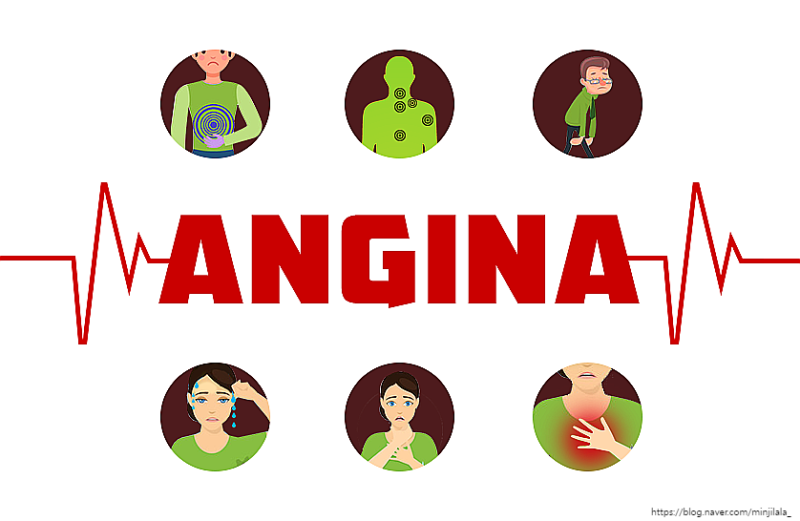 협심증 angina pectoris 증상 종류 심전도 치료 (+안정형 불안정형 이형성) (+CAG CABG PTCA PCI ...