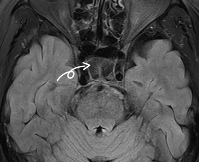 empty sella 아주 쉽게 간단히 MRI로 알아보기 : 네이버 블로그
