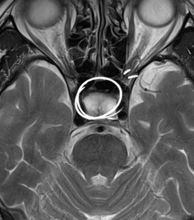 empty sella 아주 쉽게 간단히 MRI로 알아보기 : 네이버 블로그