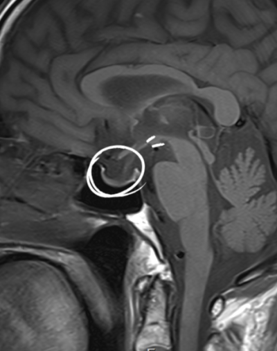 empty sella 아주 쉽게 간단히 MRI로 알아보기 : 네이버 블로그