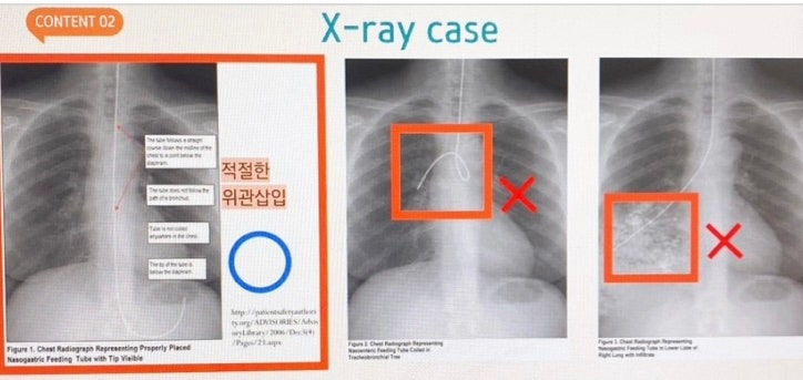 간호사가 알려주는 L-tube 준비, 삽입, 관리방법! 비위관은 어떻게 준비할까? : 네이버 블로그
