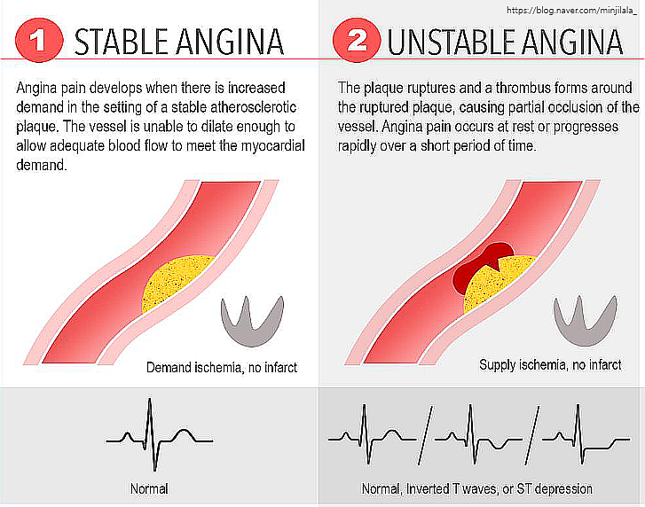 협심증 angina pectoris 증상 종류 심전도 치료 (+안정형 불안정형 이형성) (+CAG CABG PTCA PCI ...