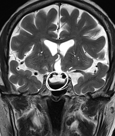 empty sella 아주 쉽게 간단히 MRI로 알아보기 : 네이버 블로그