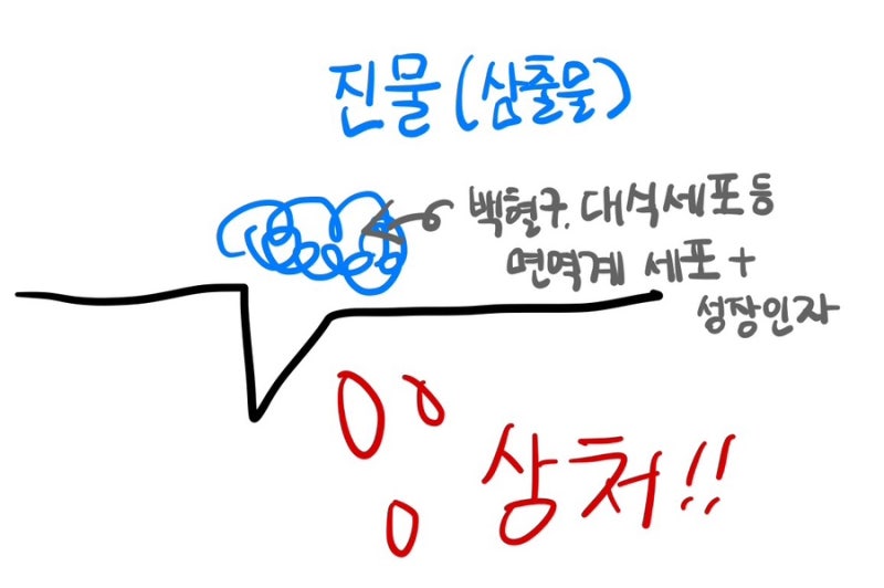 여러분들을 위한 약이야기 약사가 들려주는 상처 습윤밴드 종류 비교 하이드로겔 And 하이드로콜로이드and 폼 차이 약국 습윤