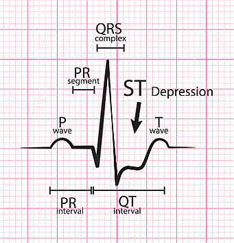 심근경색 MI myocardial infarction 증상 원인 검사 심전도 치료 시술 수술 AMI ACS STEMI ...