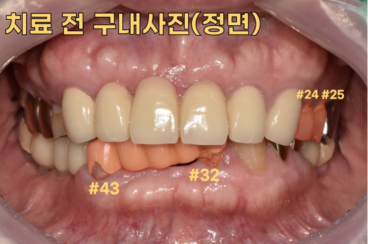대구치과 에서 임플란트 와 신경치료 과정을 쉽게 설명드릴게요