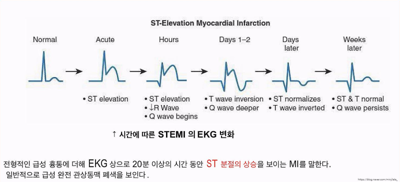 심근경색 MI myocardial infarction 증상 원인 검사 심전도 치료 시술 수술 AMI ACS STEMI ...