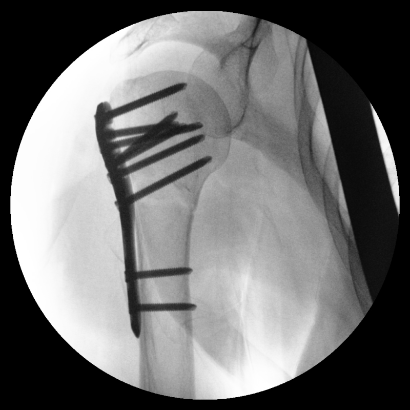 어깨골절 상완골 근위부골절 Proximal Humerus Fracture 금속판 Vs 금속정 수술방법 완벽정리 네이버 블로그