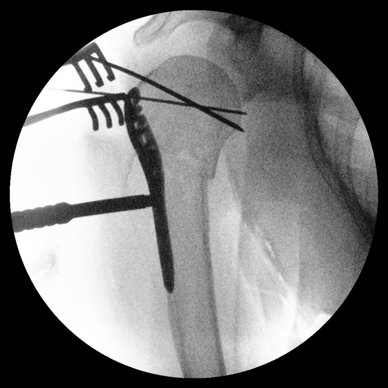 어깨골절 상완골 근위부골절 Proximal Humerus Fracture 금속판 Vs 금속정 수술방법 완벽정리 네이버 블로그