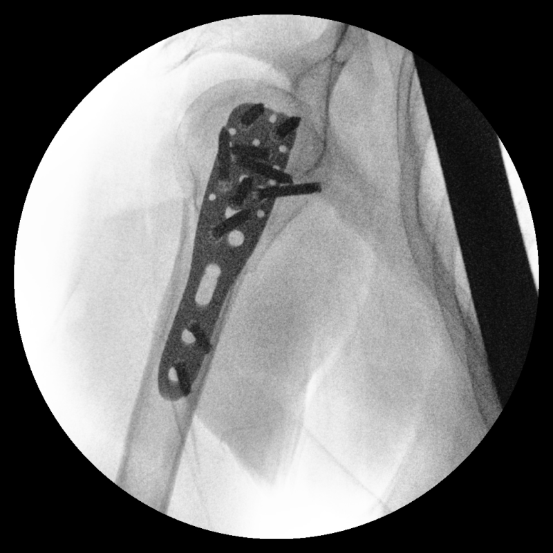 어깨골절 상완골 근위부골절 Proximal Humerus Fracture 금속판 Vs 금속정 수술방법 완벽정리 네이버 블로그
