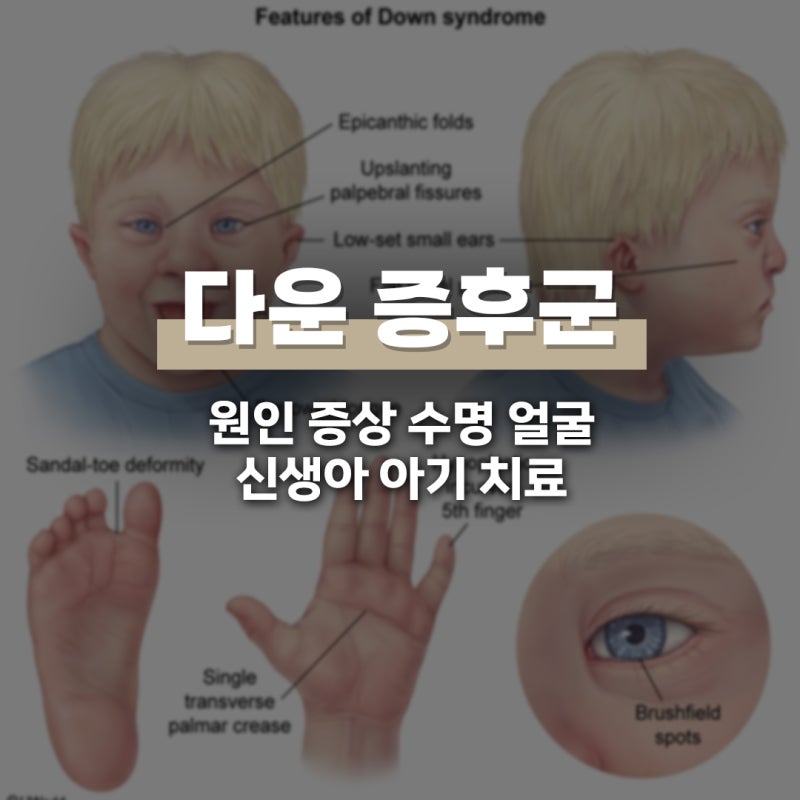 다운증후군 치료 원인 수명 증상 얼굴 검사 아기 신생아 네이버 블로그