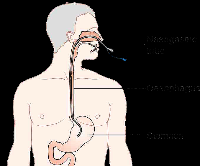 비위관(Levin tube, L/T) 삽입 목적, 방법, 관리법과 주의사항 : 네이버 블로그