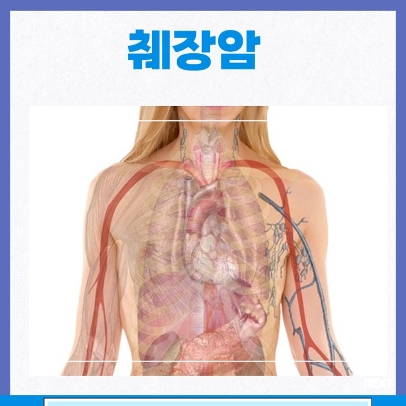 췌장암 초기증상 췌장암 등통증 위치 원인 말기 증상 치료 수술 네이버 블로그