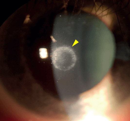 노안을 교정하는 여러가지 방법들을 알려드리겠습니다. : 네이버 블로그