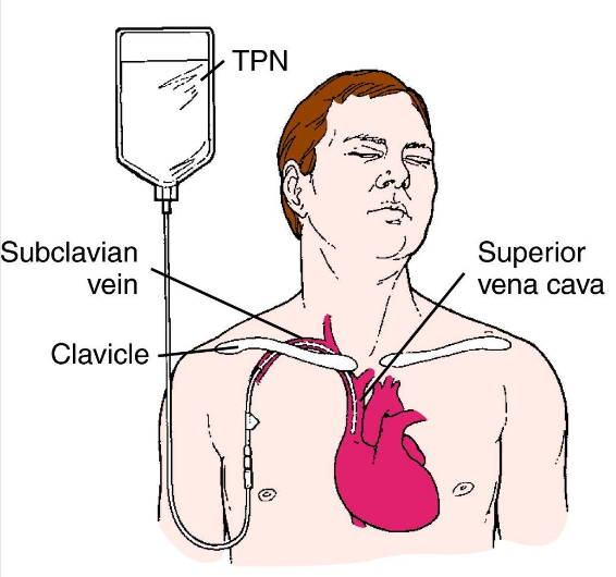 [TPN] 중심정맥영양법 Total Parenteral Nutrition/단백 아미노산 제제 산정 코드, 급여기준 : 네이버 블로그