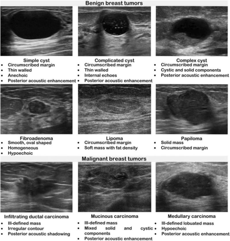 유방초음파 (Overview of ultrasonography) : 네이버 블로그