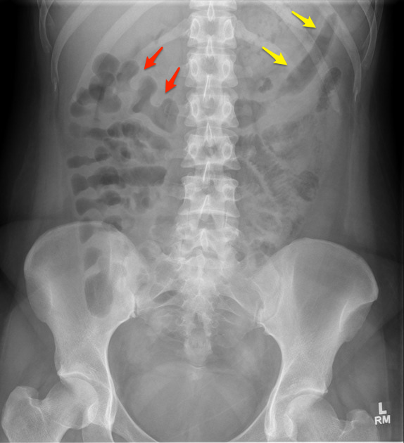 복부 X-RAY : 네이버 블로그