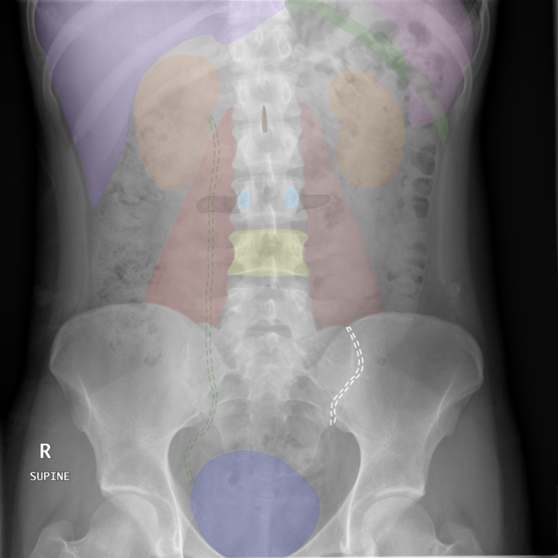 복부 X-RAY : 네이버 블로그