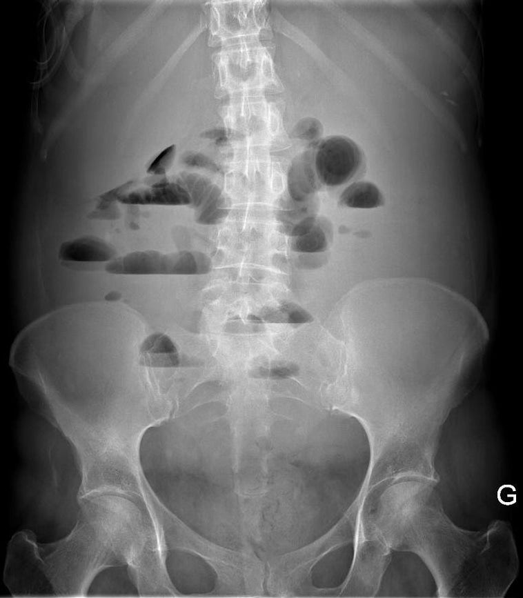 복부 X-RAY : 네이버 블로그