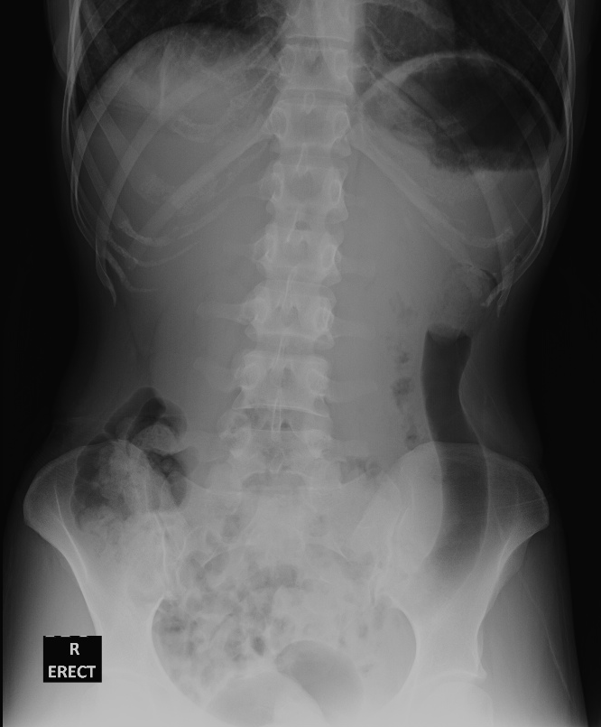 복부 X-RAY : 네이버 블로그