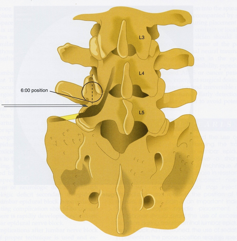 [외래/주사/척추]L-SNRB Selective Nerve Root Block /transforaminal block ...