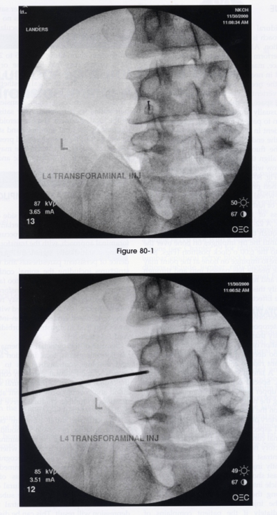 [외래/주사/척추]L-SNRB Selective Nerve Root Block /transforaminal block ...
