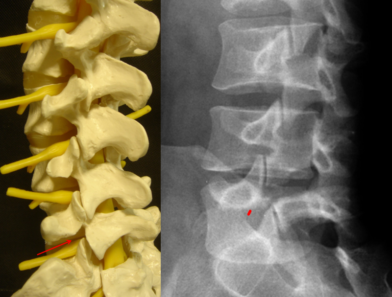 [외래/주사/척추]L-SNRB Selective Nerve Root Block /transforaminal block ...